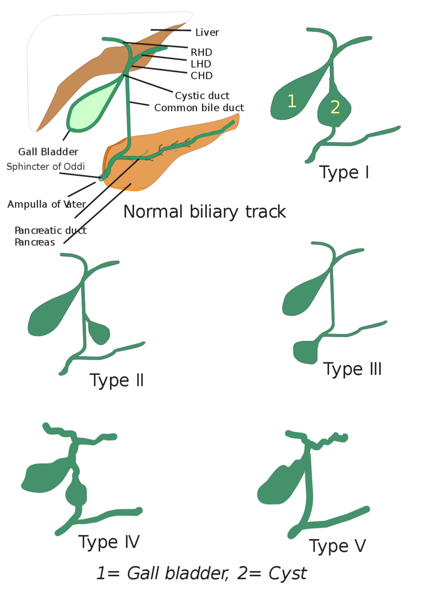 Choledochal Cysts | UCSF Department of Surgery